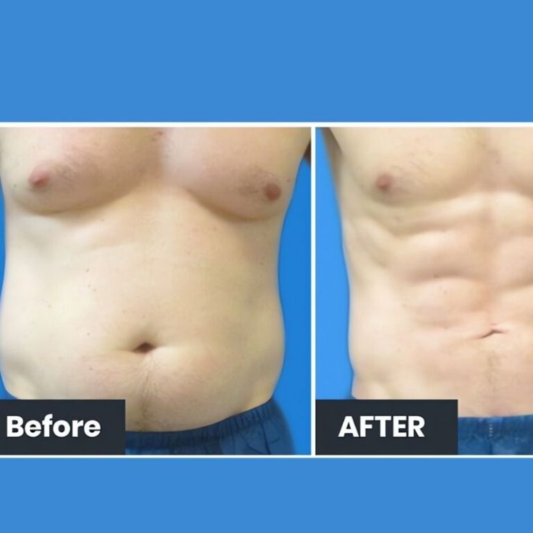 Sono Bello Laser Liposuction