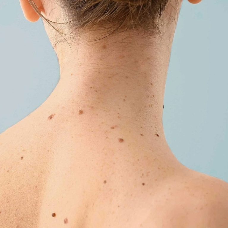 Natura Pro Skin Tag Remover